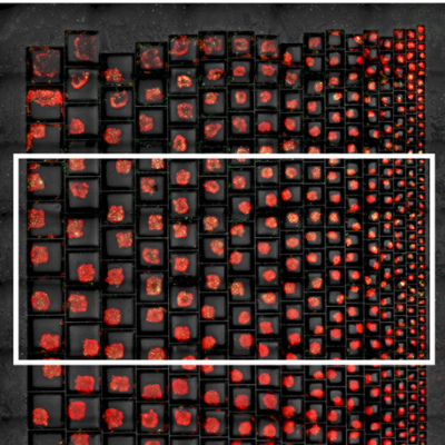 Researchers develop new technique to study "microcancers" and screen ...