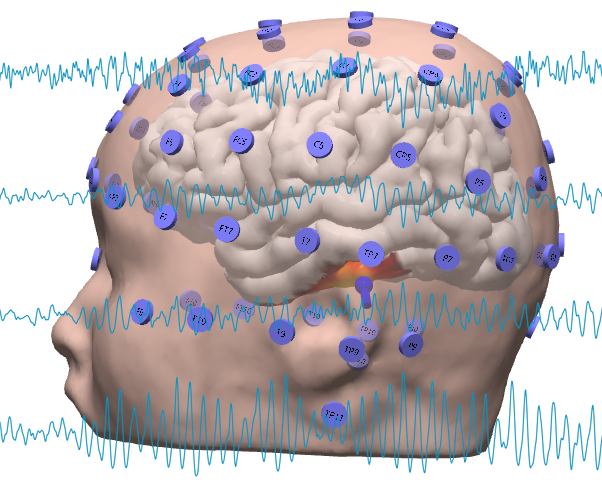New research uses machine learning to predict epilepsy surgery outcomes ...
