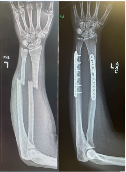 Brainstorming Solutions to (Re)Fractures | Bioengineering | Illinois