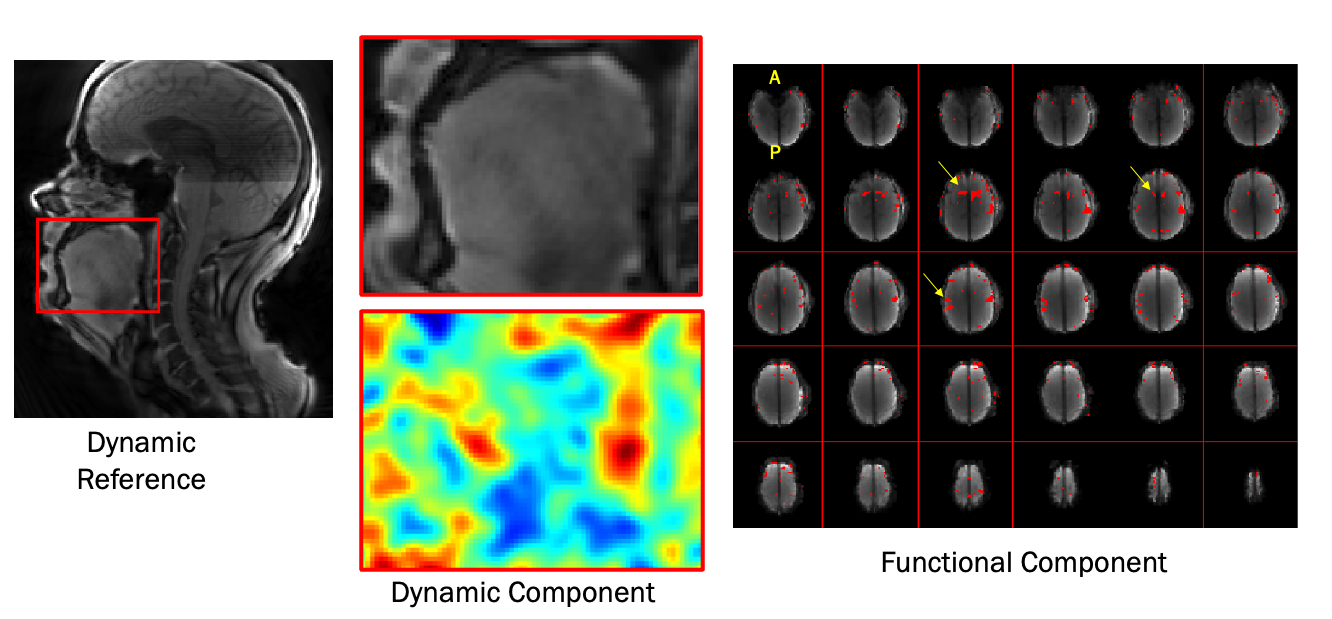 Crunching the Data: MRI-Powered Research Maps the Brain's Role in ...